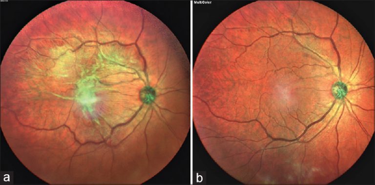 Epiretinal Membranes / Cellophane Maculopathy – Mr. Kirti M Jasani